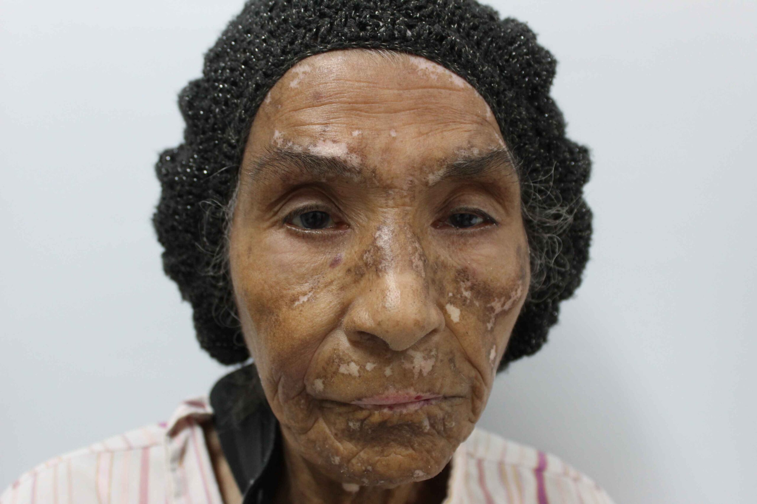 Lúpus eritematoso discoide (LED) - Negro Atlas Dermatologia inclusiva