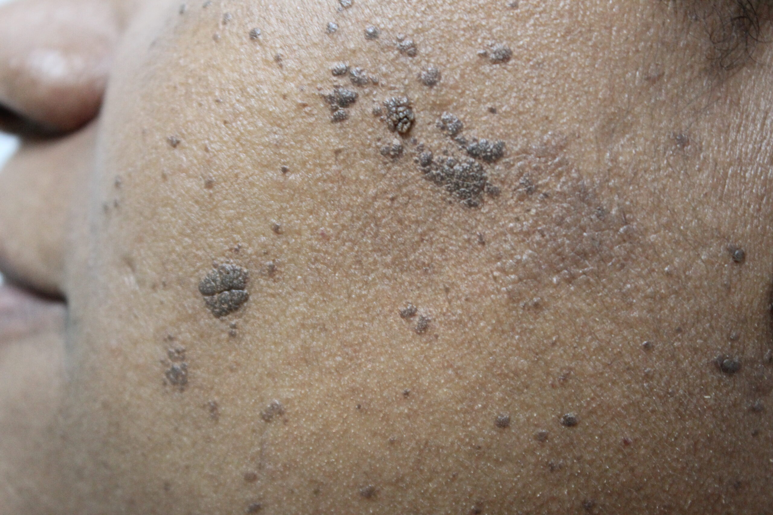 Dermatose papulosa nigra (DPN) - NegroAtlas Dermatologia Inclusiva