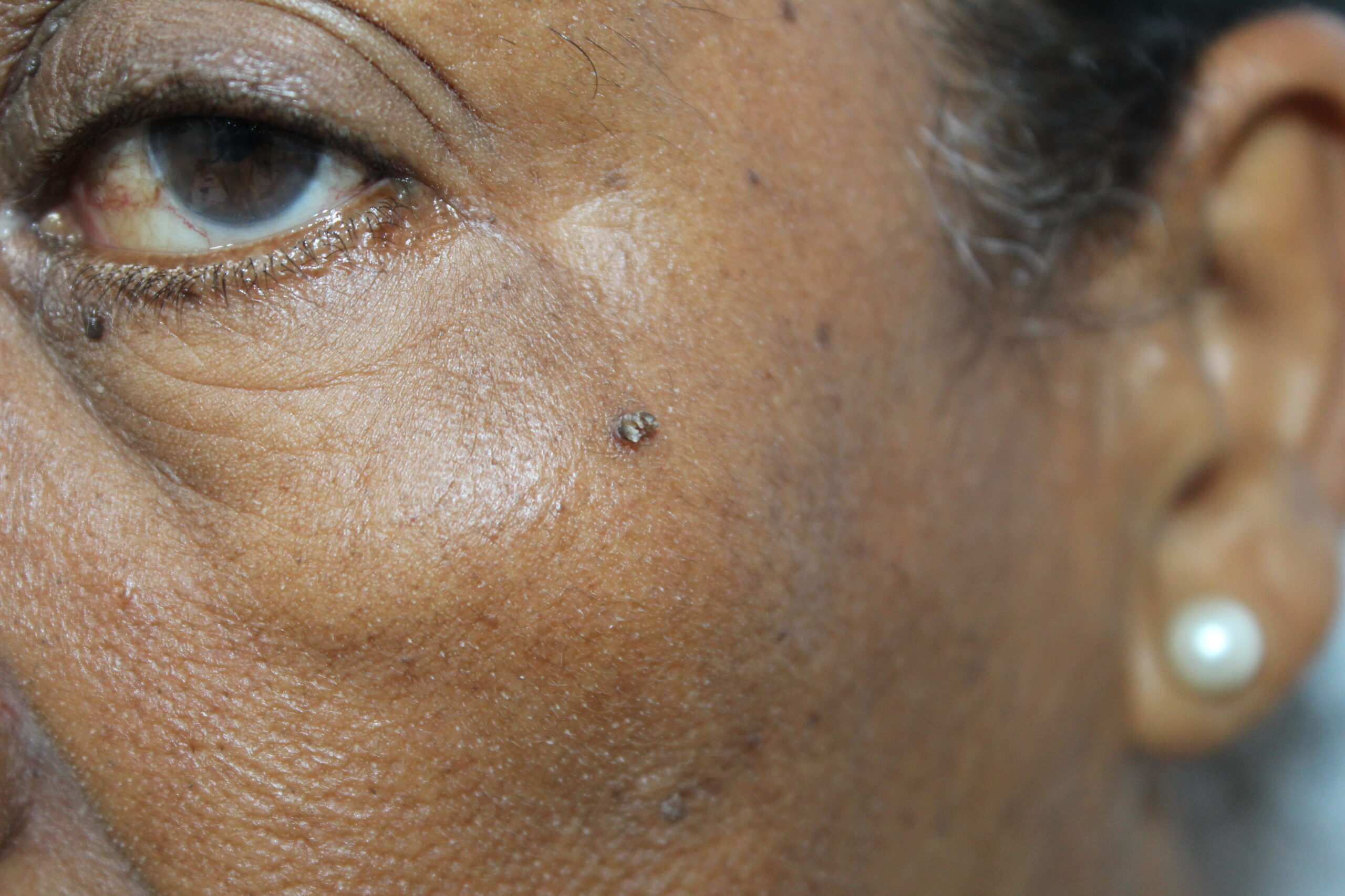 Verruga filiforme - NegroAtlas Dermatologia Inclusiva