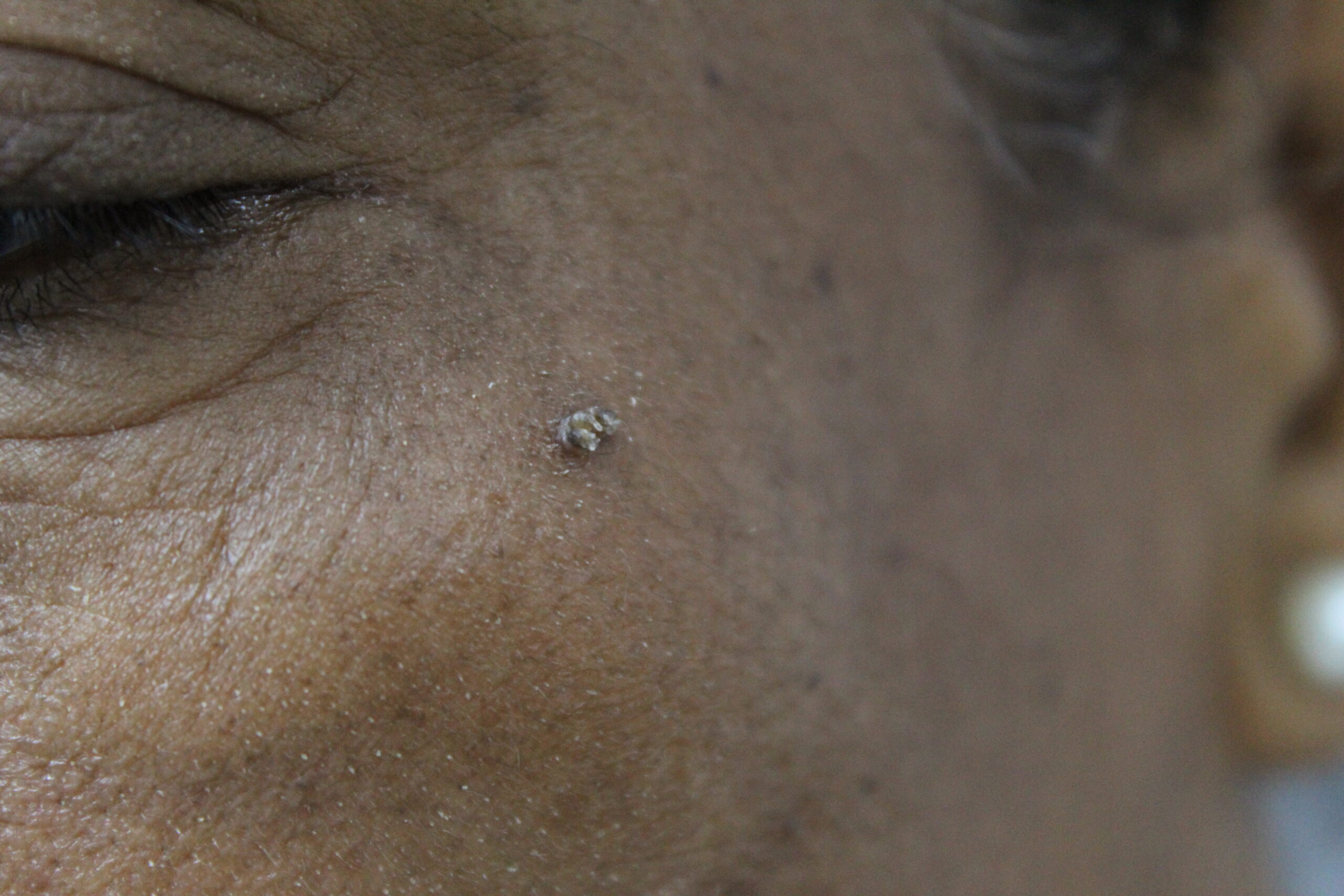 Verruga filiforme - NegroAtlas Dermatologia Inclusiva