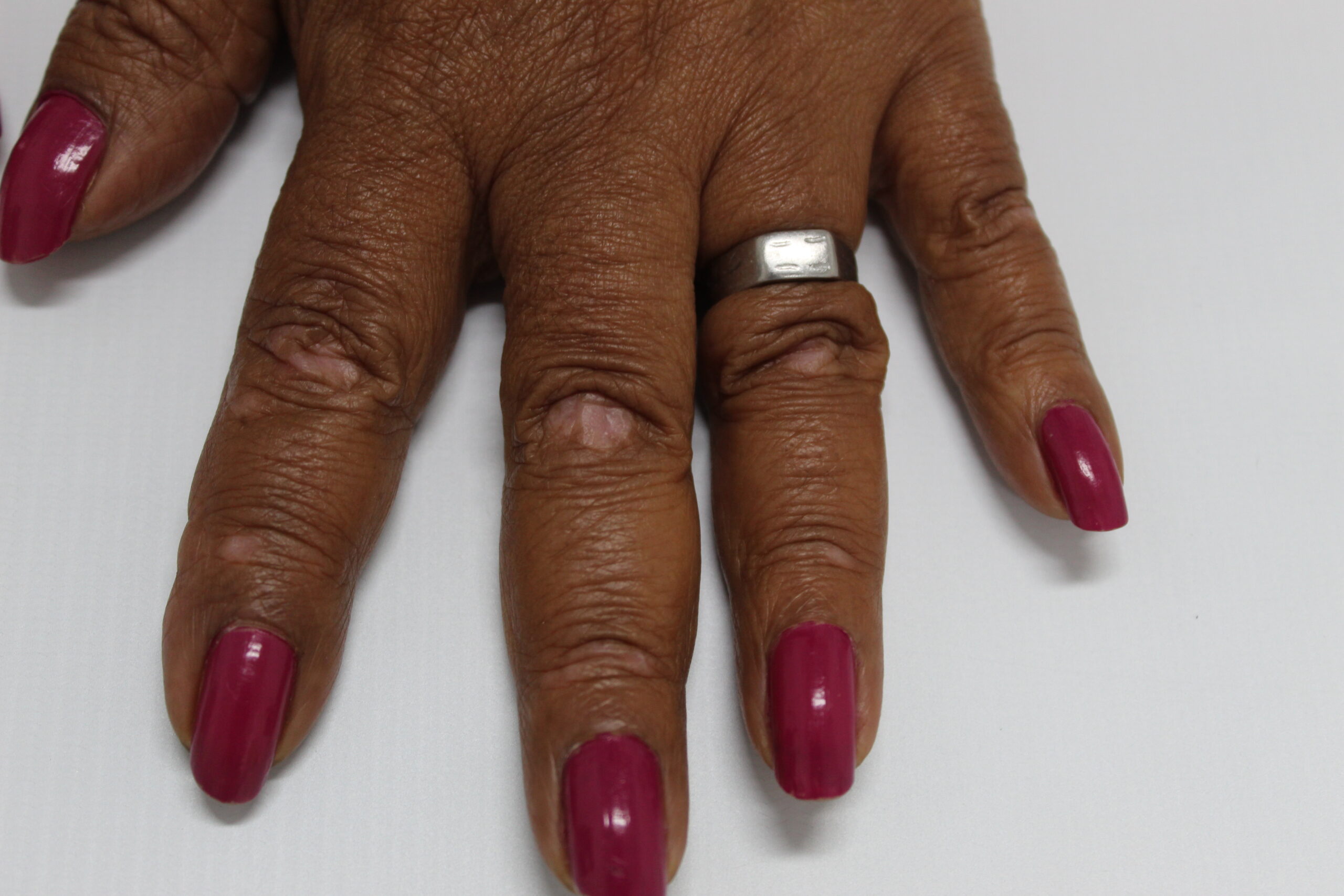 Nódulos de Gottron - NegroAtlas Dermatologia Inclusiva
